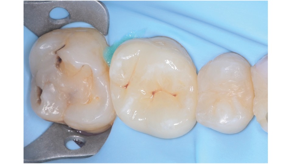 Venus® Pearl Shade Guide