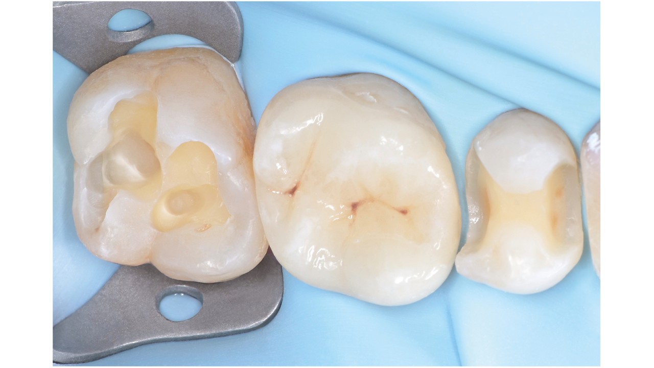 Venus® Pearl Shade Guide